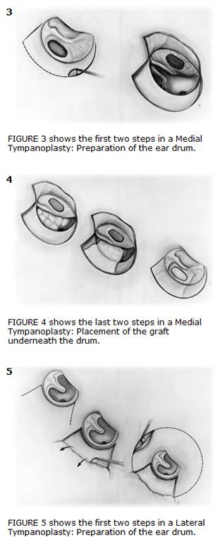 Tympanoplasty (Repairing Ear Drums) - Michigan Ear Institute